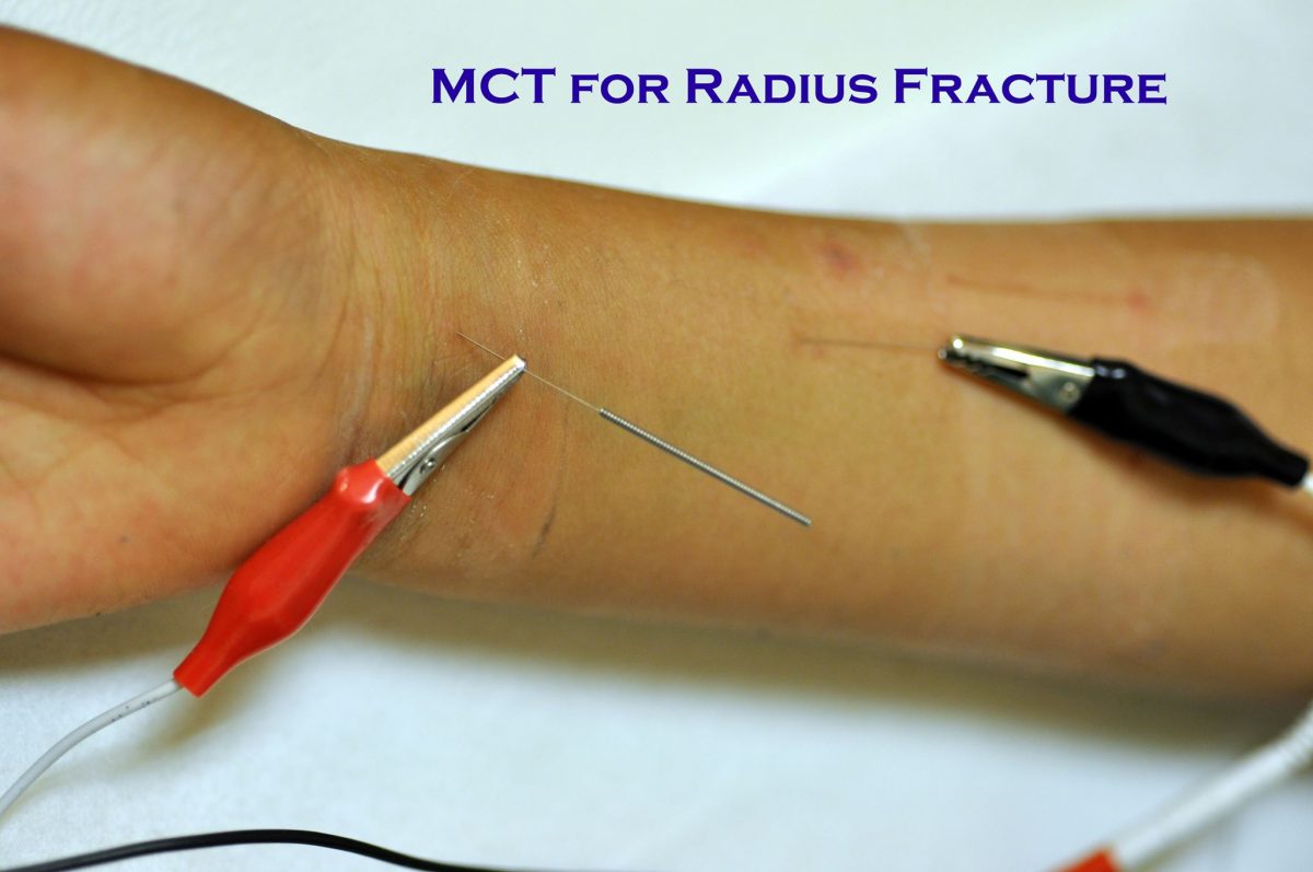 Muscle Channel Technique Certification (MCT) / Subcutaneous Electrical ...